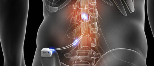 Spinal Cord Stimulator - Advanced Spine and Pain: Orthopedic ...